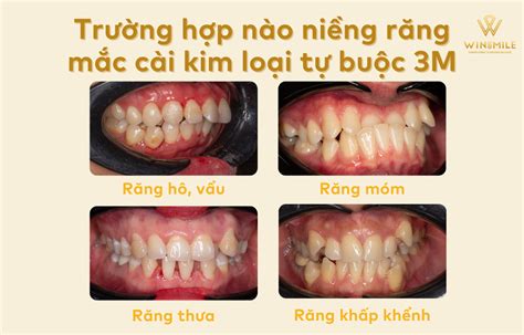 Trường Hợp Nào Dùng được Mắc Cài Kim Loại Tự Buộc 3m