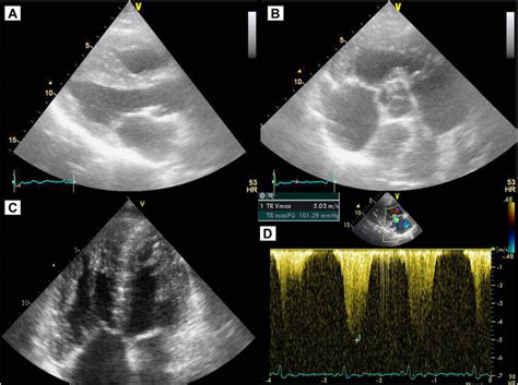 Pre Treatment Transthoracic Echocardiogram Download Scientific Diagram