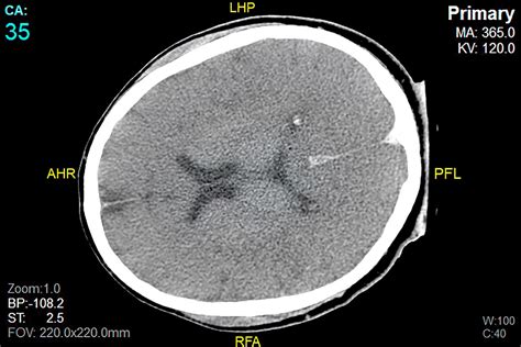 Fig3 Post Mortem Ct Examination Shows No Fractures Or Bleeding In The