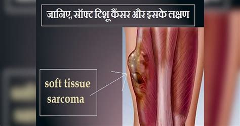 Stage 2 Soft Tissue Cancer Liposarcoma Successful Surgery 3 Kg Tumor