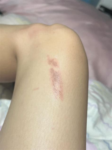 今天被鐵棍燙傷😭 很擔心好好的一雙腿留疤⋯⋯ 我有先去藥局買了一條藥師推薦的 叫美巴寧 但上網看不太到什麼評價 求求廣大串友有沒有推薦針對燙傷