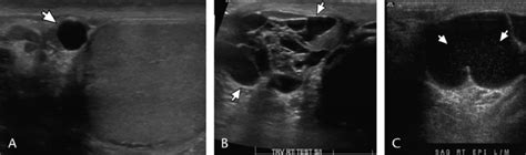 Epididymal Cyst Diagram