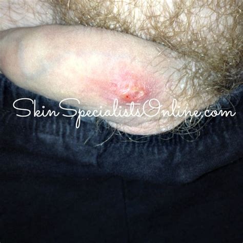Ask A Skin Doctor Cellulitis Skin Specialists Online