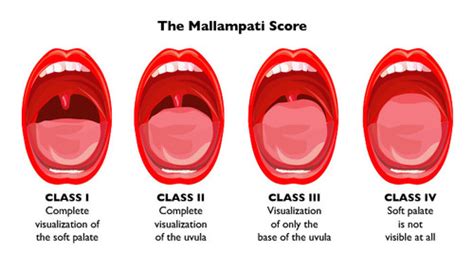 Anesthesia Lecturio Quizlet