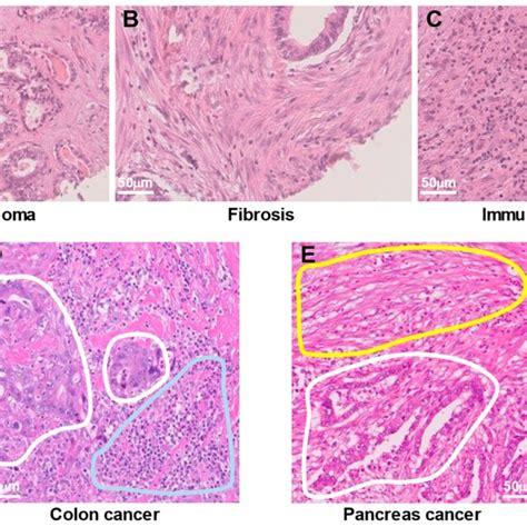 Heterogeneous Cell Populations In Human Cancer Tissue A C Download Scientific Diagram