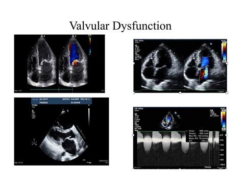 Basics Of Tte Trans Tracheal Echoand Teepptx