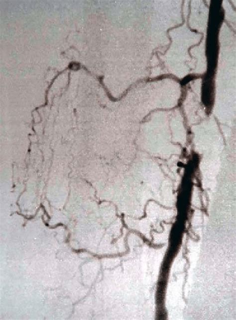 Short Segment Occlusion Of The Right Superficial Femoral Artery