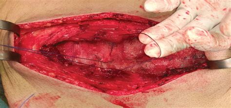 Posterior Component Separation With Transversus Abdominis Re