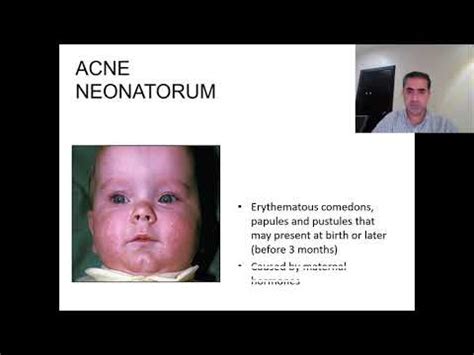 Neonatal Rash Youtube