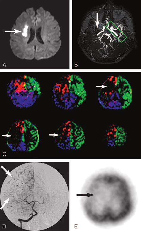RPI In A 50 Year Old Man With MCA Occlusion A DWI Showing Acute
