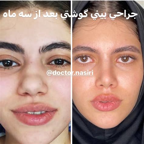 ‎دکتر داریوش نصیری جوزانی‎ ‎جراحي بيني گوشتي بعد از سه ماه توسط دكتر