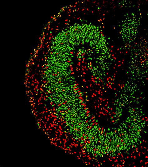 Ucla Researchers Find How Epilepsy Genes Disrupt Different Brain Regions Using Stem Cell Models
