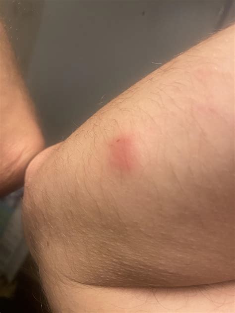 Was Bitten By An Assassin Bug Nymph Last Week There Was Nothing At