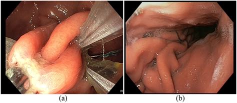 A Endoscopic Sleeve Gastroplasty With The Endomina Suturing System