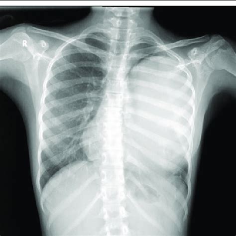 Chest X Ray Image Of The Extrapulmonary Intrathoracic Hydatid Cyst In