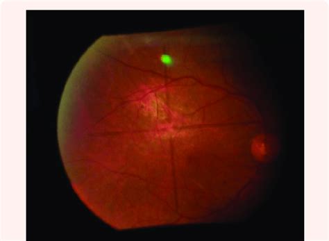 Right Eye Some Choroidal Atrophy Download Scientific Diagram