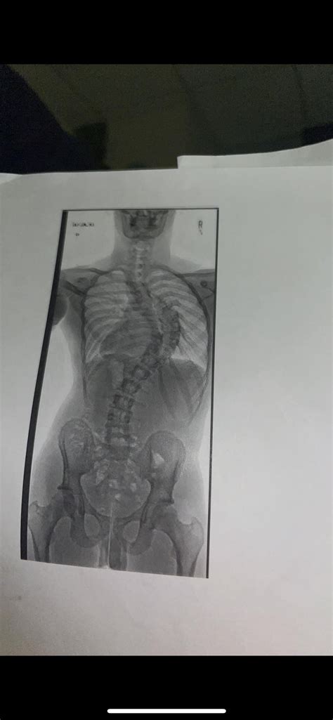 19 Yo 1 Week Post Scoliosis Surgery Ama Rscoliosis