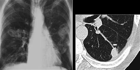 Septic Emboli A Chest X Ray Cxr And High Resolution Computed