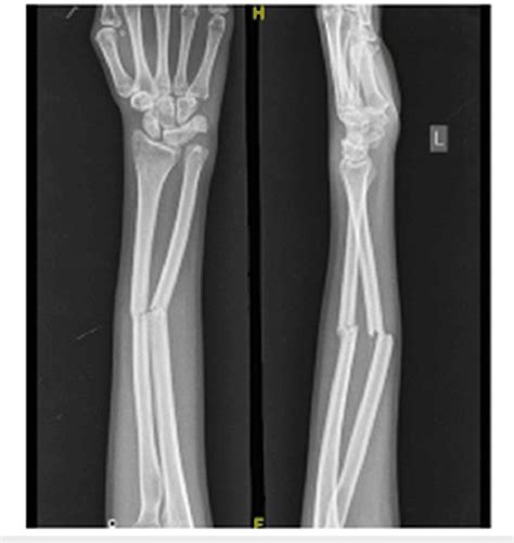 The Preoperative Forearm X Ray With Ununited Fracture Of Both Forearm