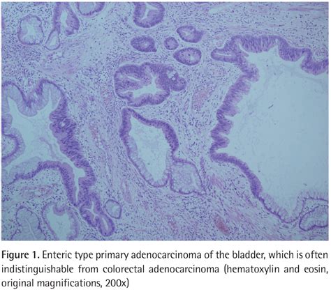 Adenocarcinoma Of The Urinary Bladder Journal Of Urological Surgery