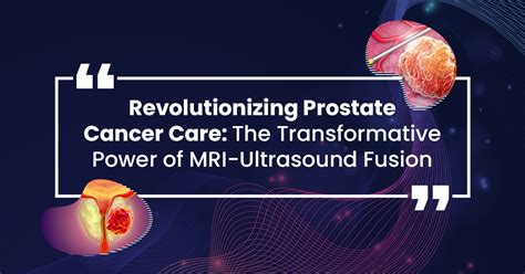 Revolutionizing Prostate Cancer Care The Transformative Power Of Mri