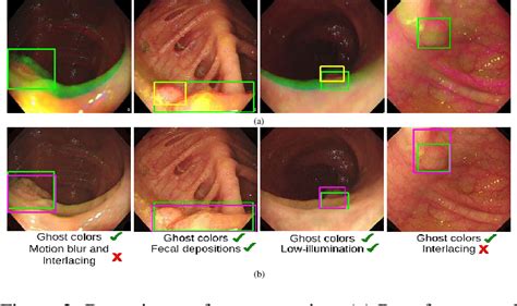 Can Adversarial Networks Make Uninformative Colonoscopy Video Frames