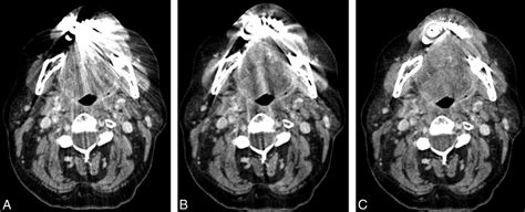 The Effects Of Metal Artifacts From Dental Hardware Are Highest With Download Scientific