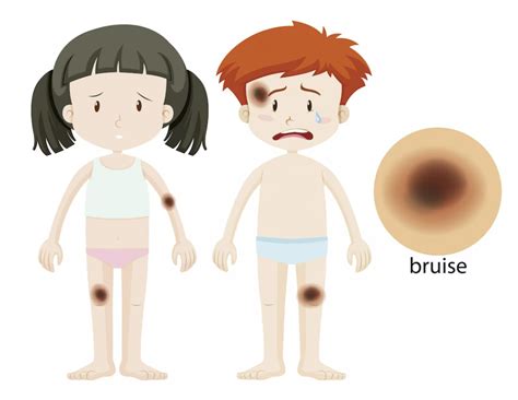 멍 빨리 빼는 법 요령과 치료법 Infozum