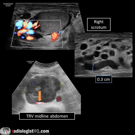 How To Detect Conjoined Lumbosacral Nerve Roots On Mri Rradiology