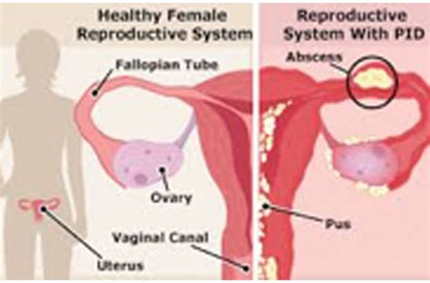 PID Pelvic Inflammatory Disease