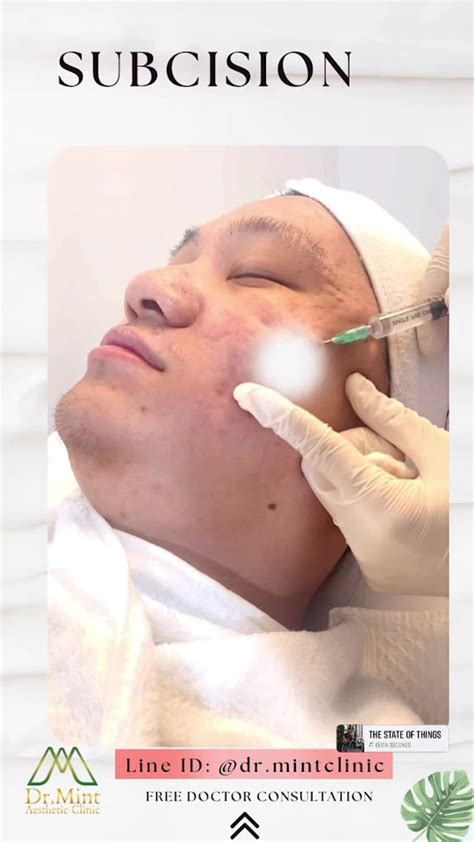 Review รักษาหลุมสิว Subcision Meso ด้วยการตัดพังผืดใต้หลุมสิว ร่วม