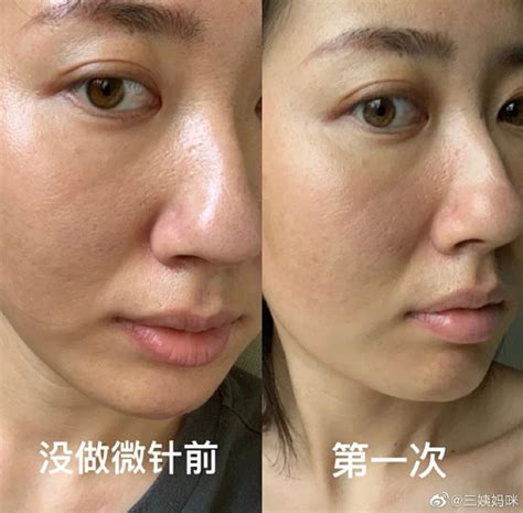 你知道混油皮毛孔粗大上装有吃妆吗？ 别的不敢说，黄金射频微珍才是护肤性价比最高的 亲身体验 同时解决皮肤，毛孔粗大，痘印痘坑，肤色暗黄 一些