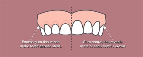 Gum Contouring Reshape Your Gums Elite Dental Group