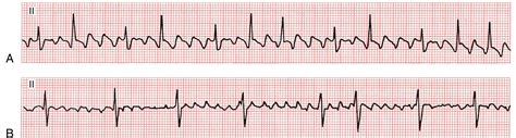 7 Atrial Flutter With Variable Block A And Coarse Atrial