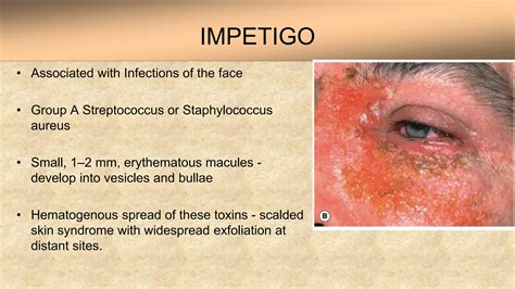 Bacterial Eyelid Infections And Blepharitis Pptx