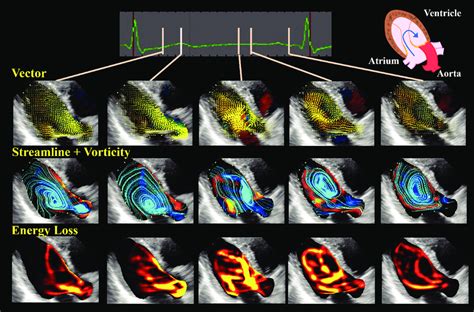 Normal Left Ventricular Flow Pattern With Vorticity And Flow Energy Download Scientific Diagram
