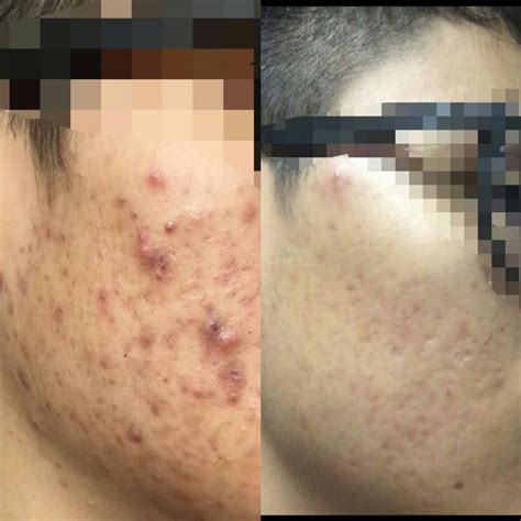 😎隆重登場😎 凹凸洞救星 修改輪廓專家（einxel Plus 重現膠原蛋白肌 ️iso膠原修復槍原理？ ️ 半導體絶緣針 雙極射頻技術