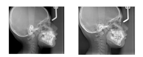 Tristar T Plus Functional Appliance Clear Aligner Material Tristar