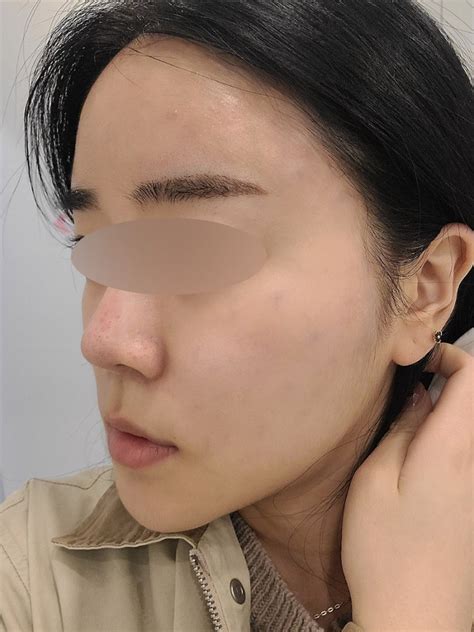 강남 피부과물광주사스킨부스터 릴리이드m맞고 온 실제후기 물광주사 가격붓기통증효과 등 리쥬란 힐러와 차이사진o 네이버 블로그