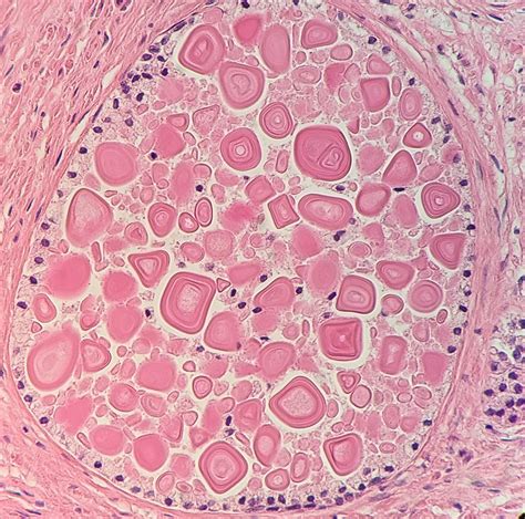 Prostatic Concretions Histology