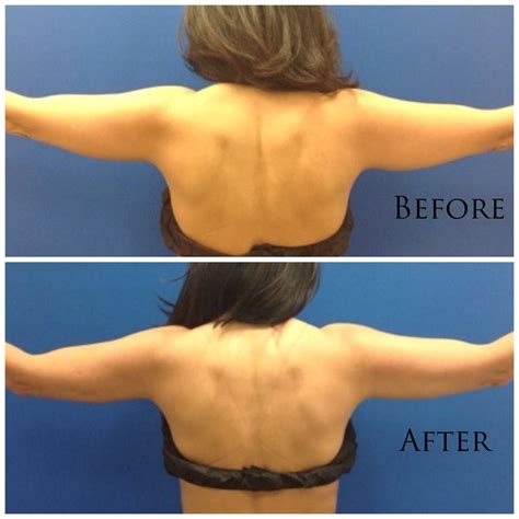 List 97 Pictures Laser Lipo Before And After Photos Full Hd 2k 4k