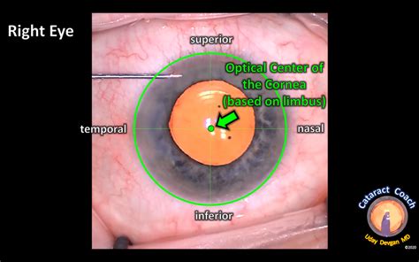 Angle Alpha And Angle Kappa With Iols Cataract Coach