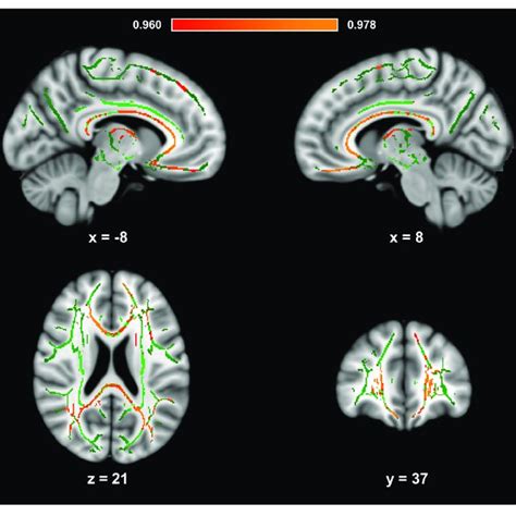 High Density Lipoprotein Cholesterol Hdl C Is Positively Associated Download Scientific