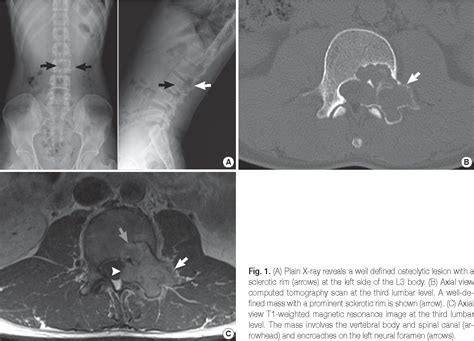 Figure 1 From Chondroblastoma Of The Lumbar Spine A Case Report And