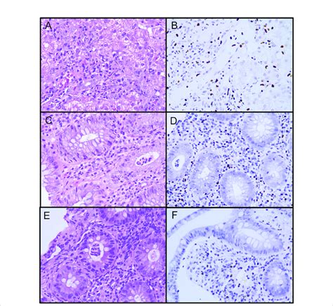 Histopathology Specimens From Patient 1 A Liver Biopsy Showing