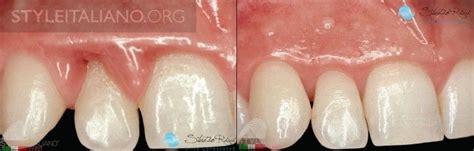 Nonsurgical Therapy To Recapture The Interproximal Papilla