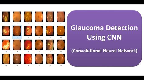 Glaucoma Detection Using Cnn Convolutional Neural Network Glaucoma Classification Using