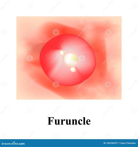 Pustules On The Skin Cystic Acne Pimples On The Skin Furuncle