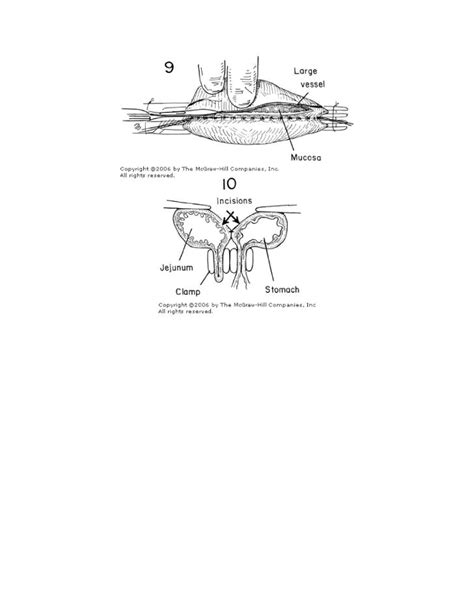 Gastrojejunostomy