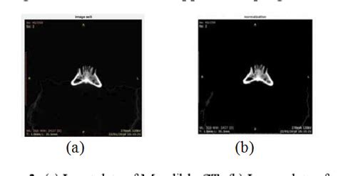 Figure 1 From Mandibular Image Segmentation On The Ct Scan Of The Head Using The Active Contour